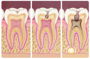 Caries: qué son, causas y factores relacionados. | Clínica Prario