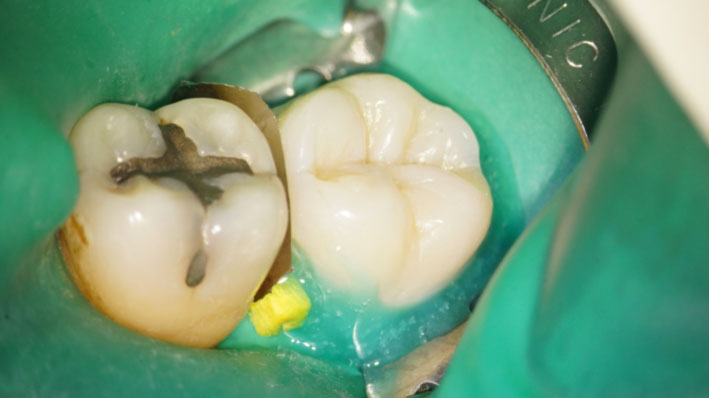 cementado | Tu Clinica Dental en Benidorm