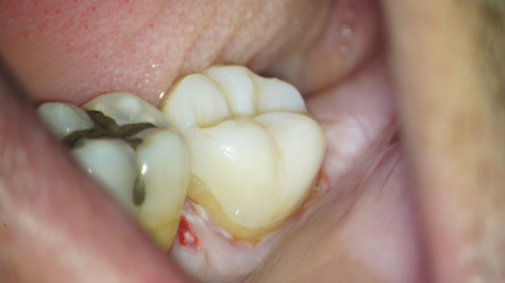 pulido | Tu Clinica Dental en Benidorm